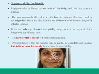 Vitiligo | PPTX