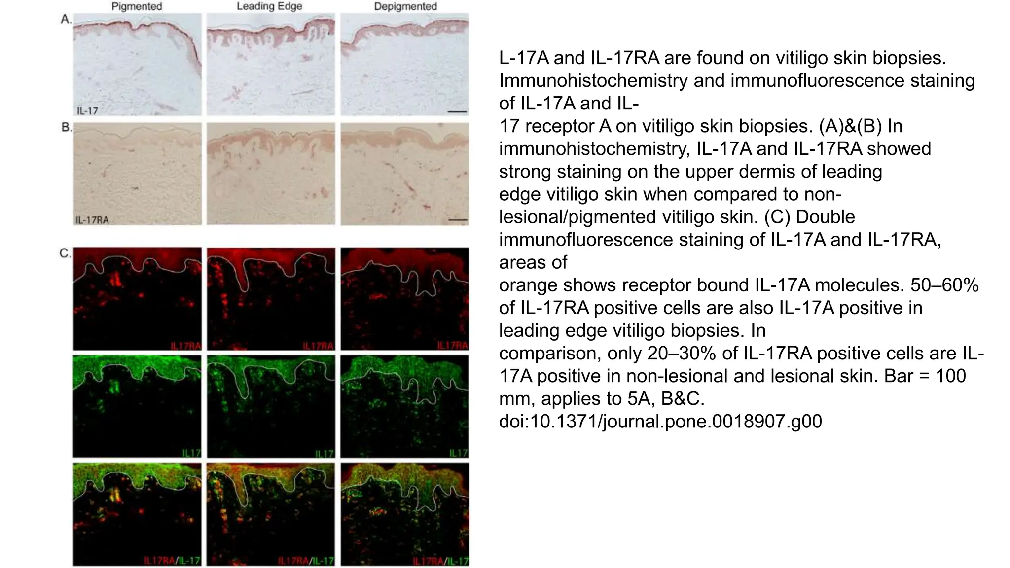 Vitiligo Pptx Psychiatric Patients Have Already Pptx