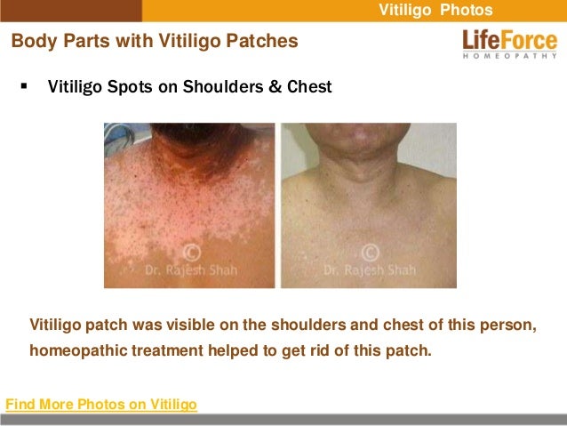 Before After Treatment Photos of Vitiligo on Head, Eyes, Hands, Lips,…