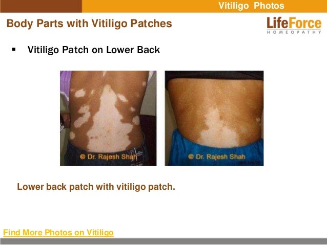 Before After Treatment Photos of Vitiligo on Head, Eyes, Hands, Lips,…