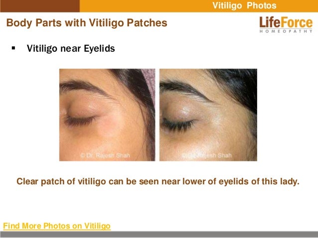 Before After Treatment Photos of Vitiligo on Head, Eyes, Hands, Lips,…