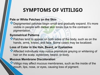 VITILIGO_CAUSES, SYMPTOMS & HOMEOPATHIC TREATMENT | PPT