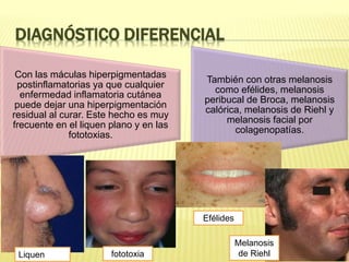 Trastornos de la pigmentación de la piel: Vitiligo, Cloasma | PPTX