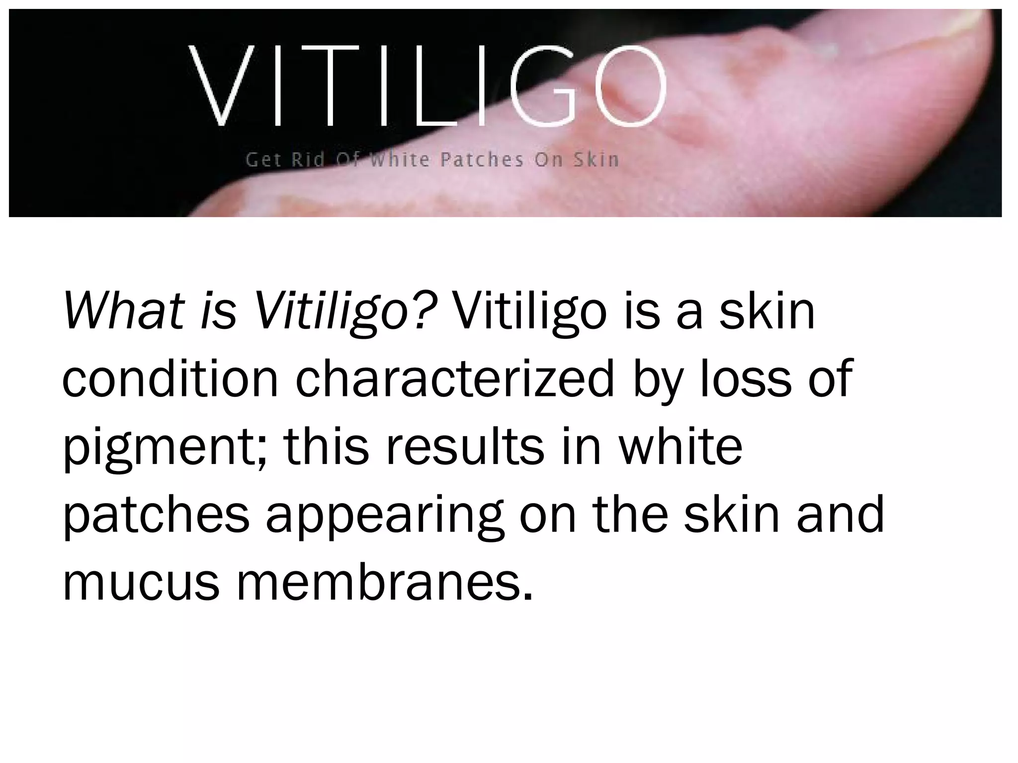 Get Rid Of White Patches On Skin - Vitilito Frequently Asked Questions ...