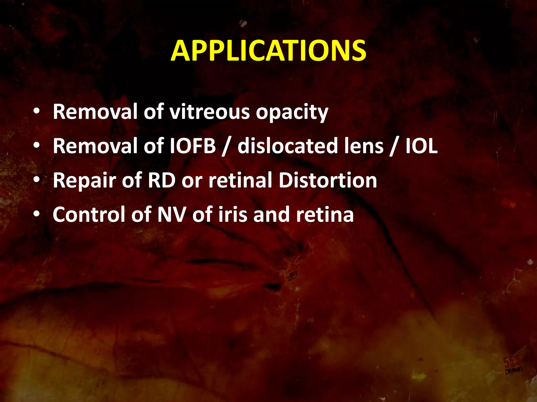 Vitrectomy | PPTX