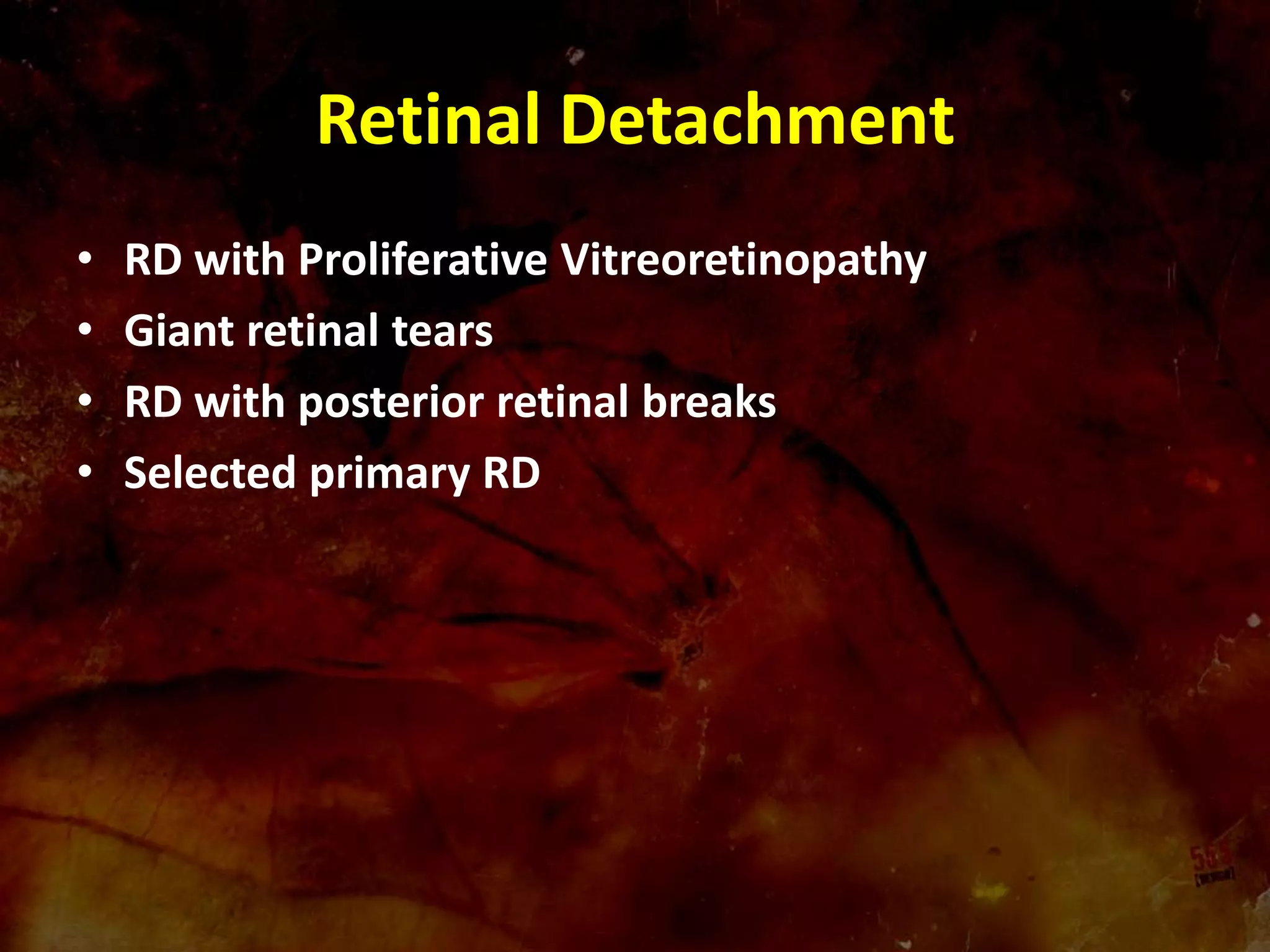 Vitrectomy | PPTX