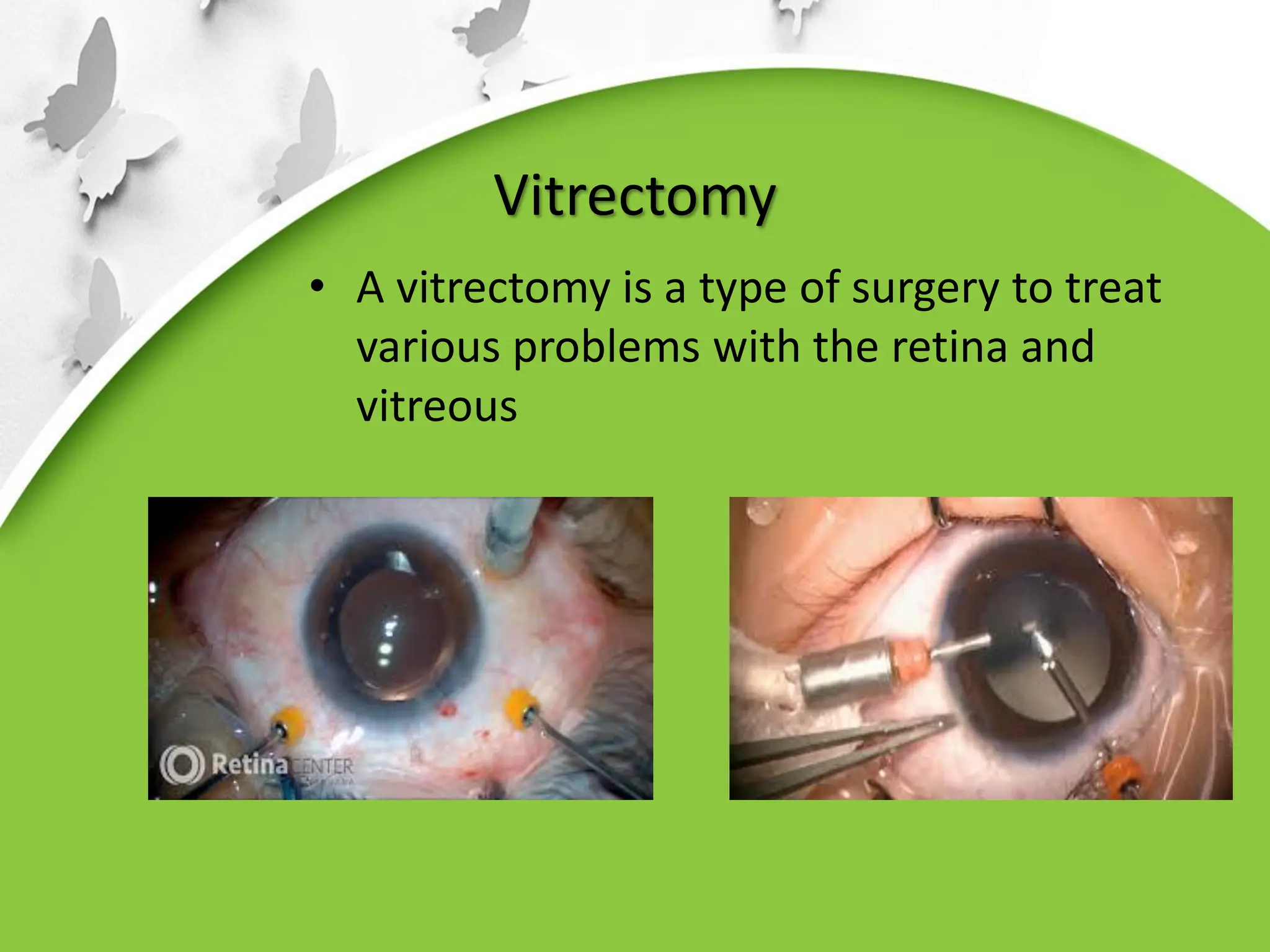 eye evaluation Vitrectomy - Anterior segment.pdf