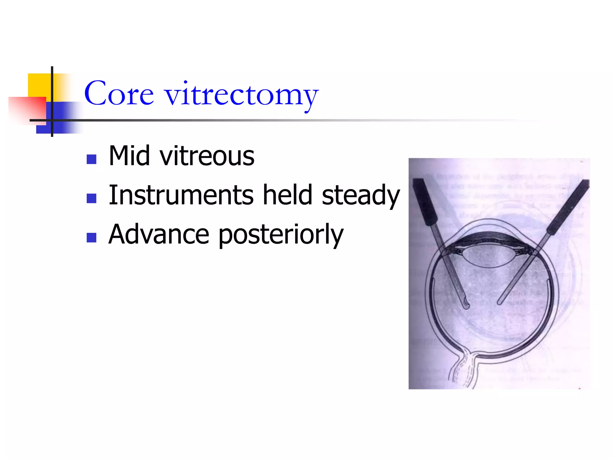 Vitrectomy Principles | PPT