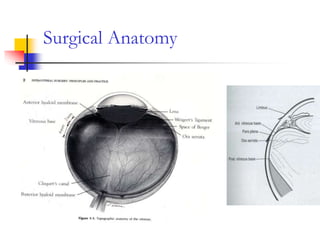 Vitrectomy Principles | PPT