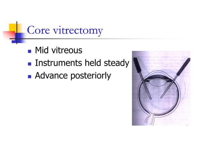Vitrectomy Principles | PPT