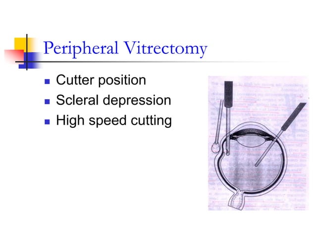 Vitrectomy Principles | PPT