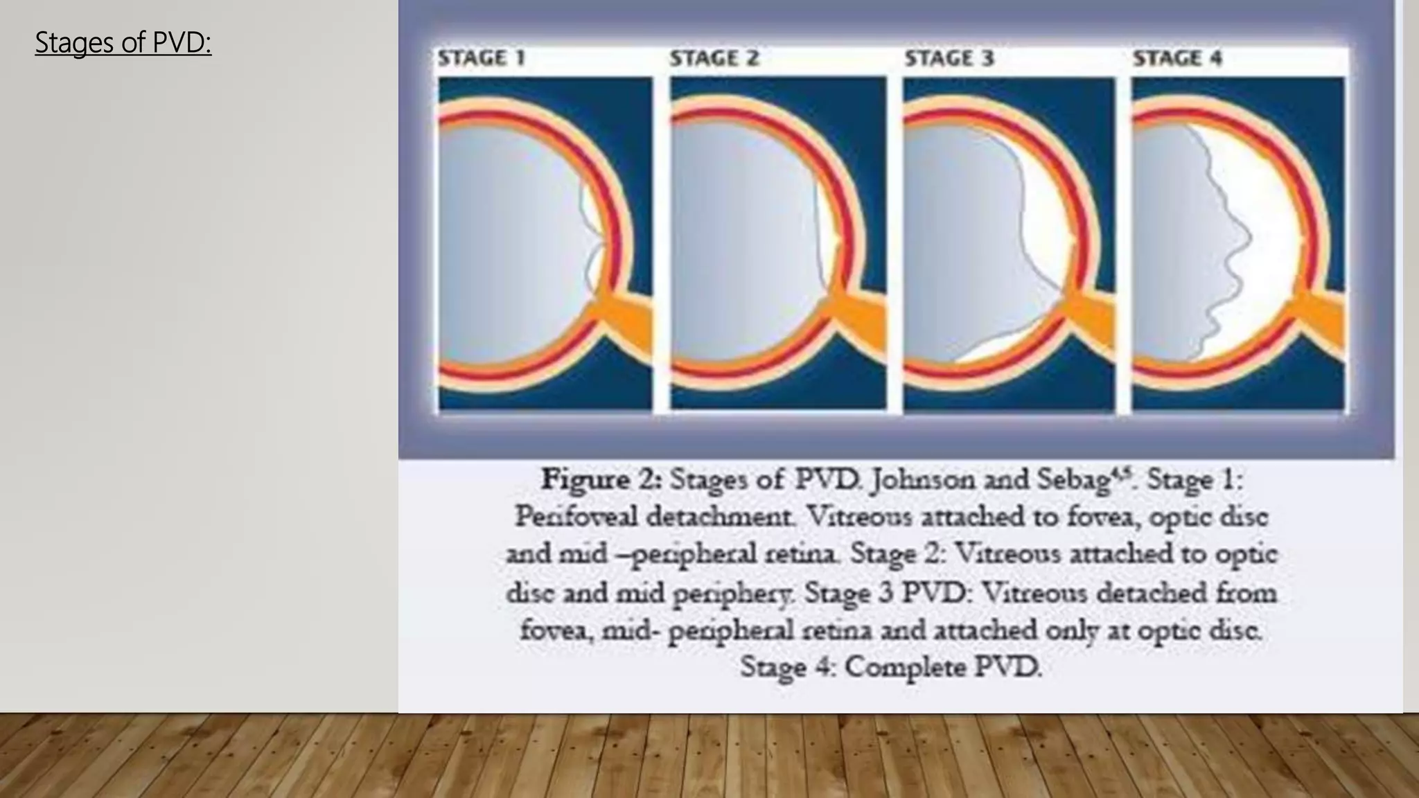 Vitreo macular interface disorder | PPTX