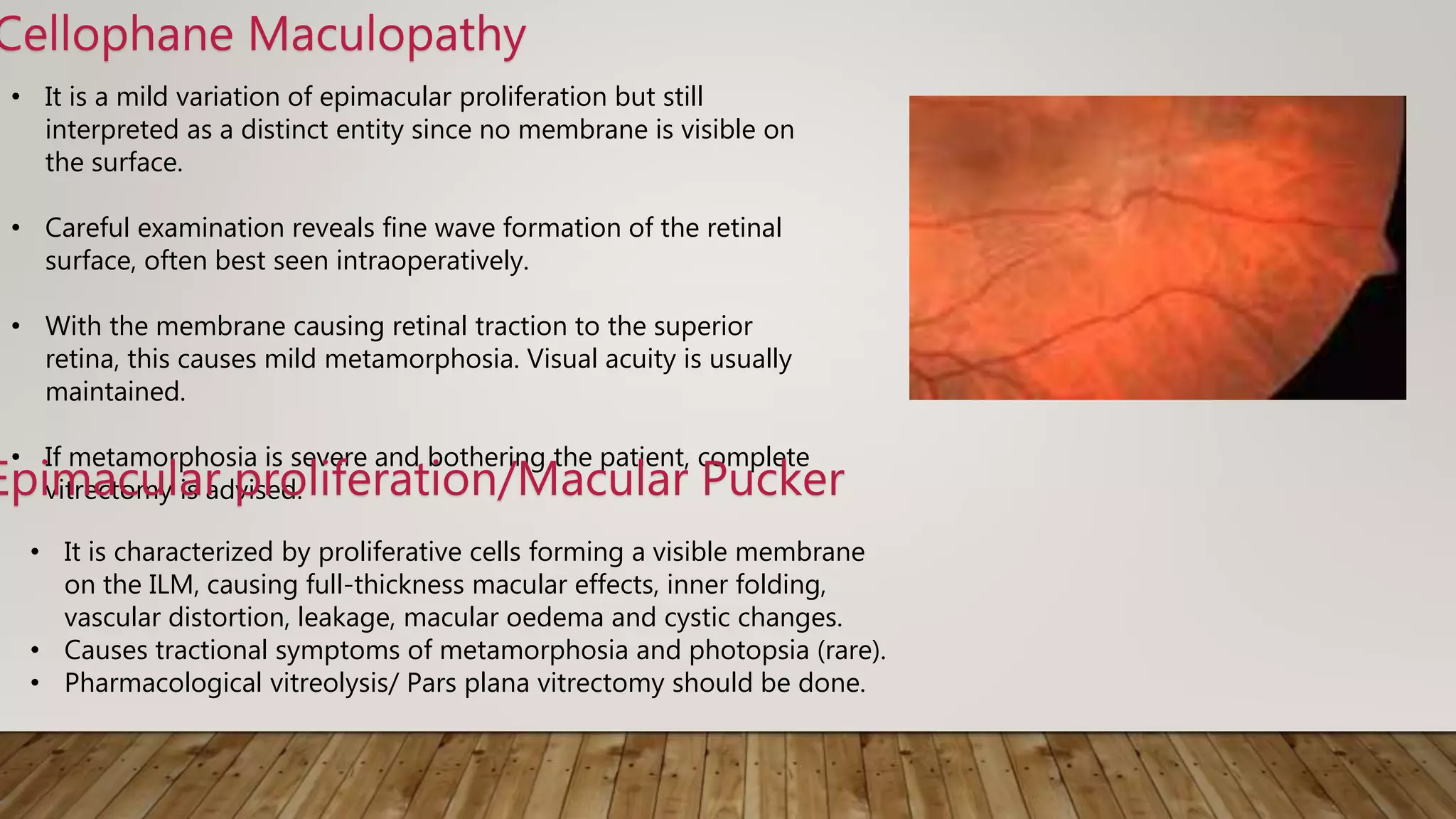 Vitreo macular interface disorder | PPTX