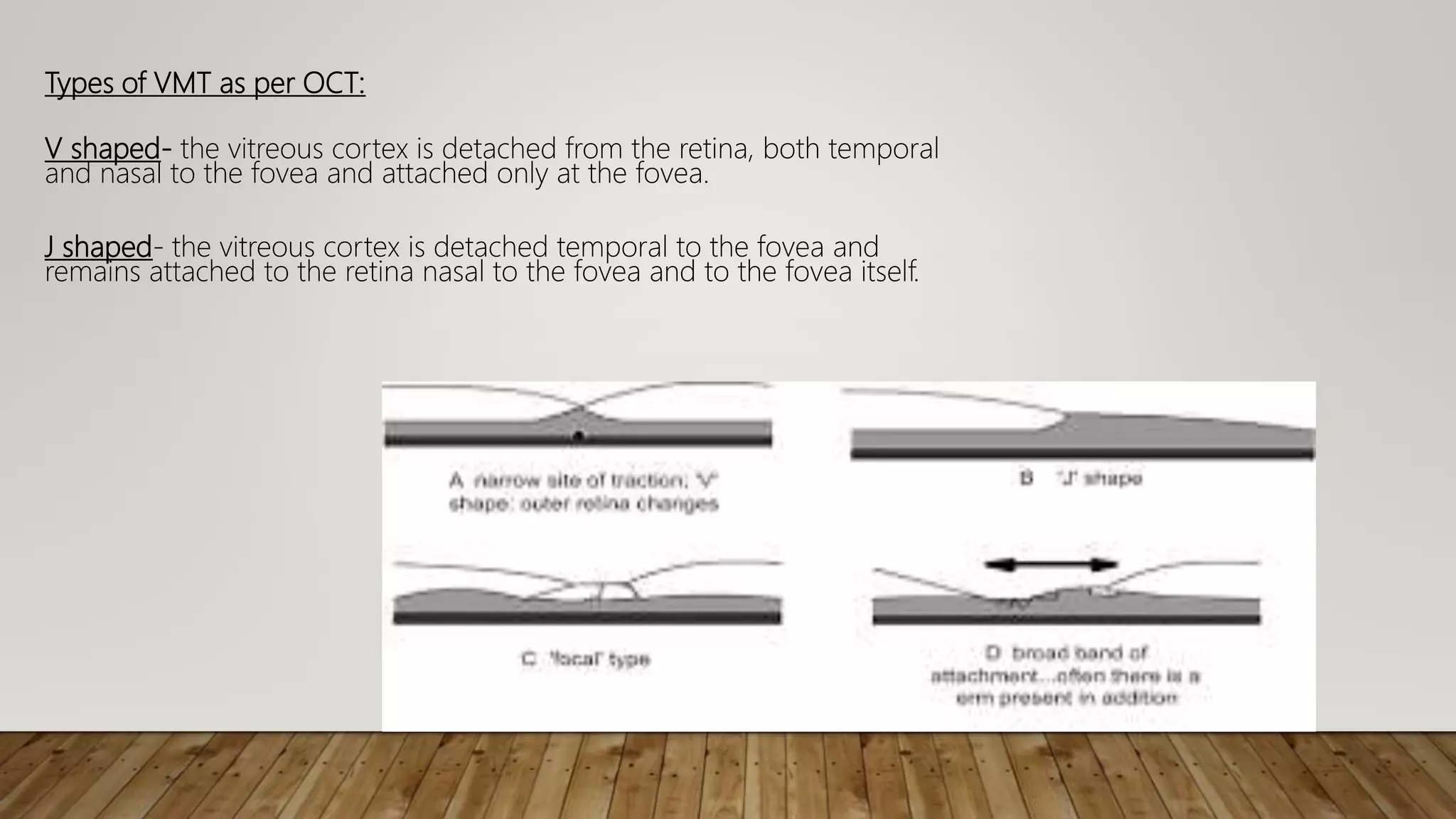 Vitreo macular interface disorder | PPTX