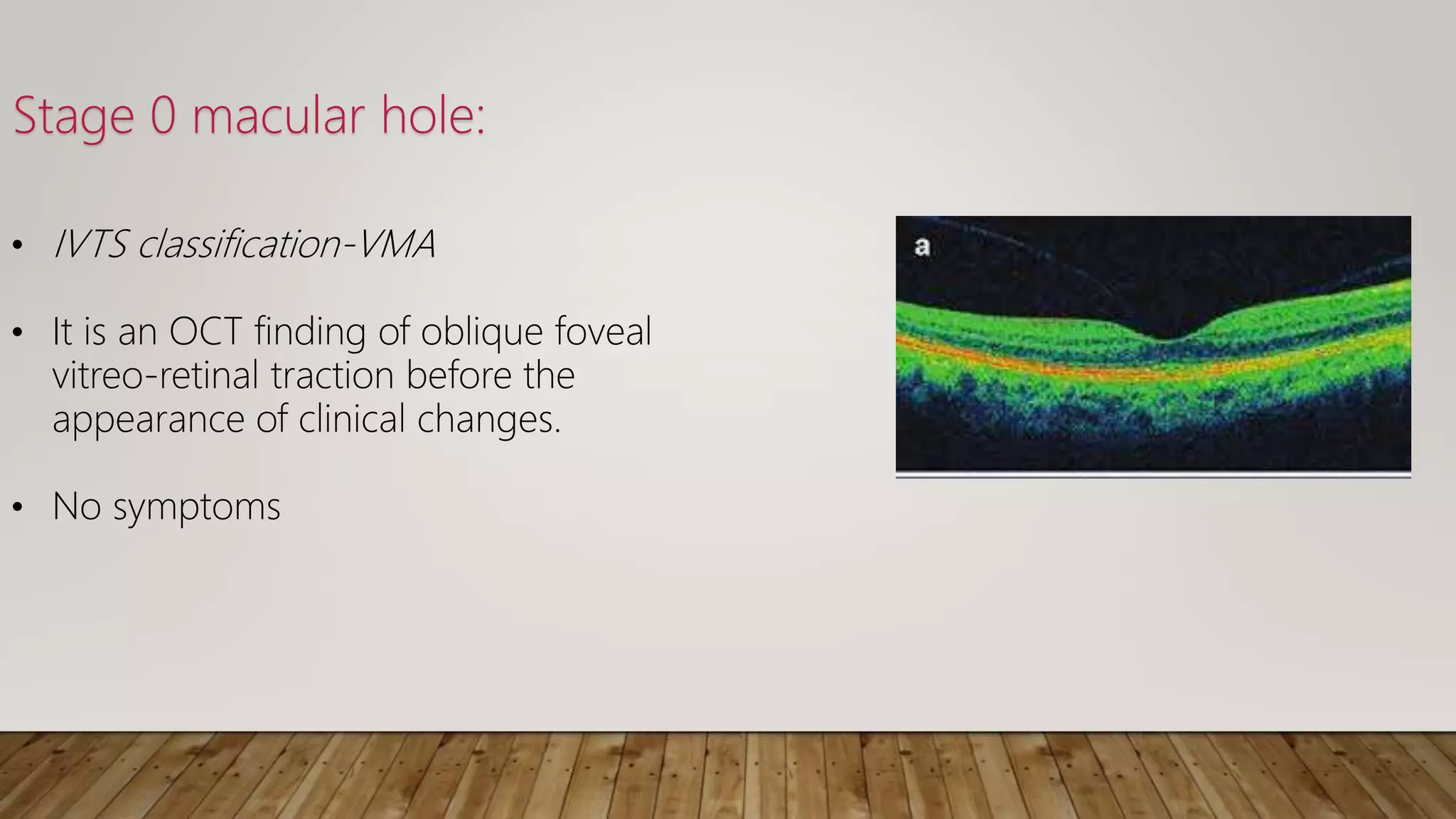 Vitreo macular interface disorder | PPTX