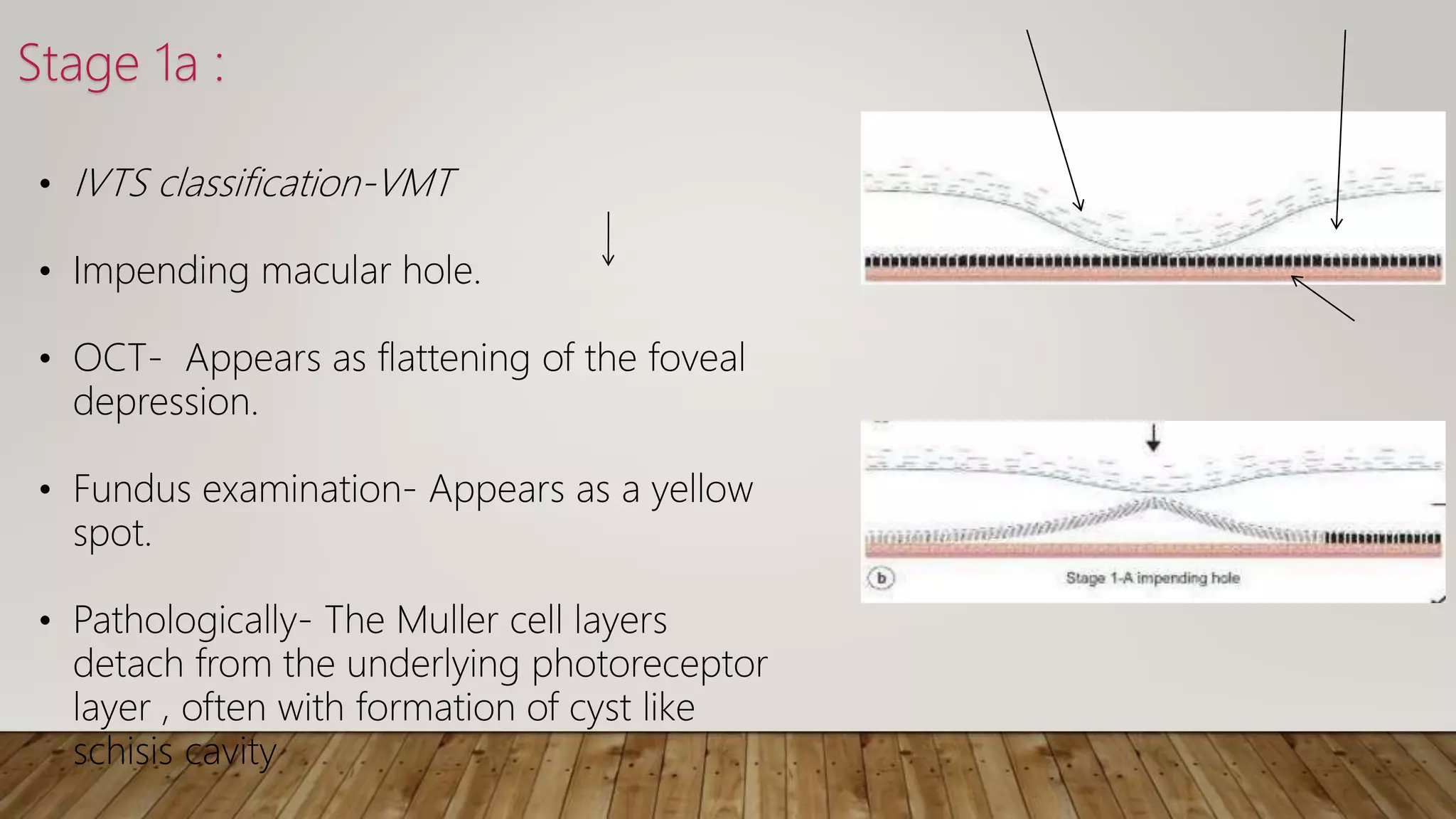 Vitreo macular interface disorder | PPTX