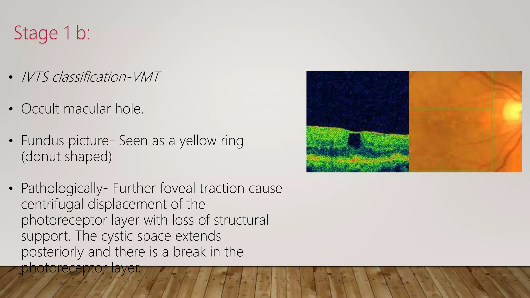 Vitreo macular interface disorder | PPTX