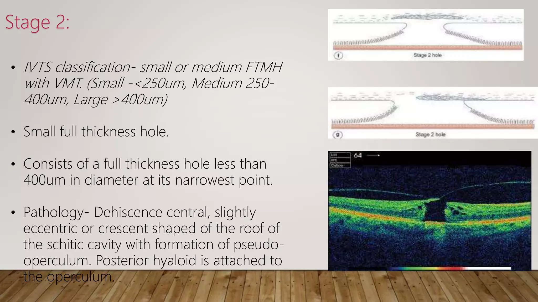 Vitreo macular interface disorder | PPTX