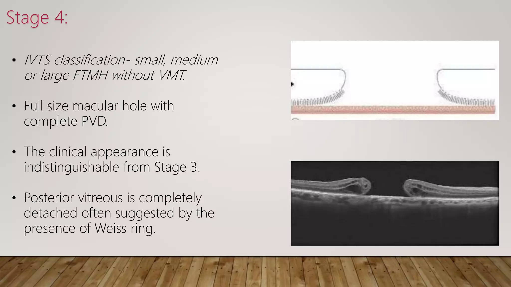 Vitreo macular interface disorder | PPTX