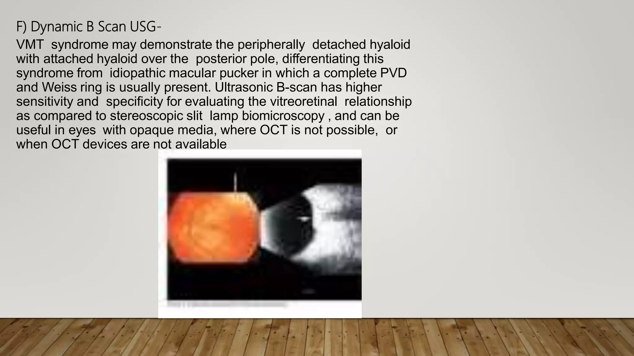 Vitreo macular interface disorder | PPTX
