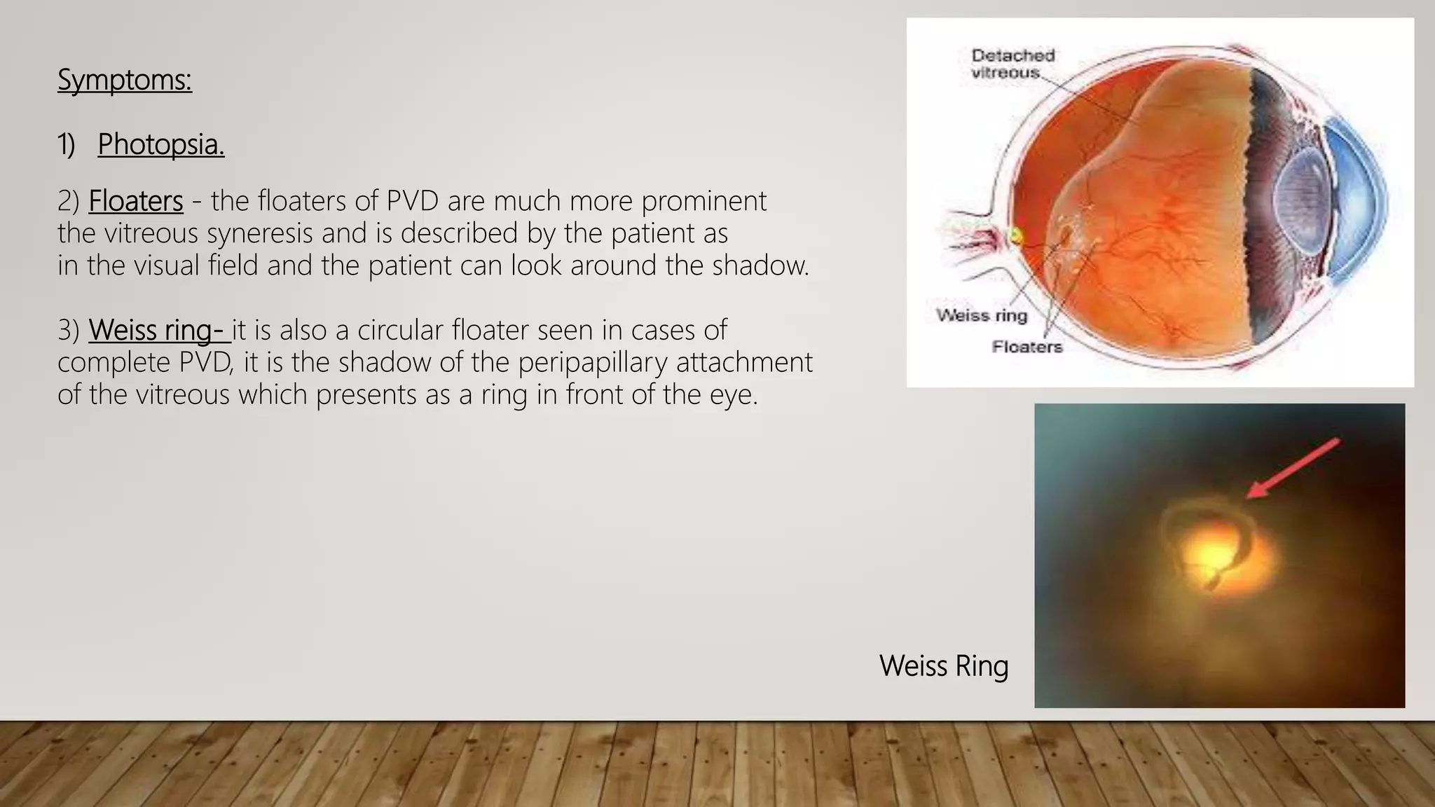 Vitreo macular interface disorder | PPTX