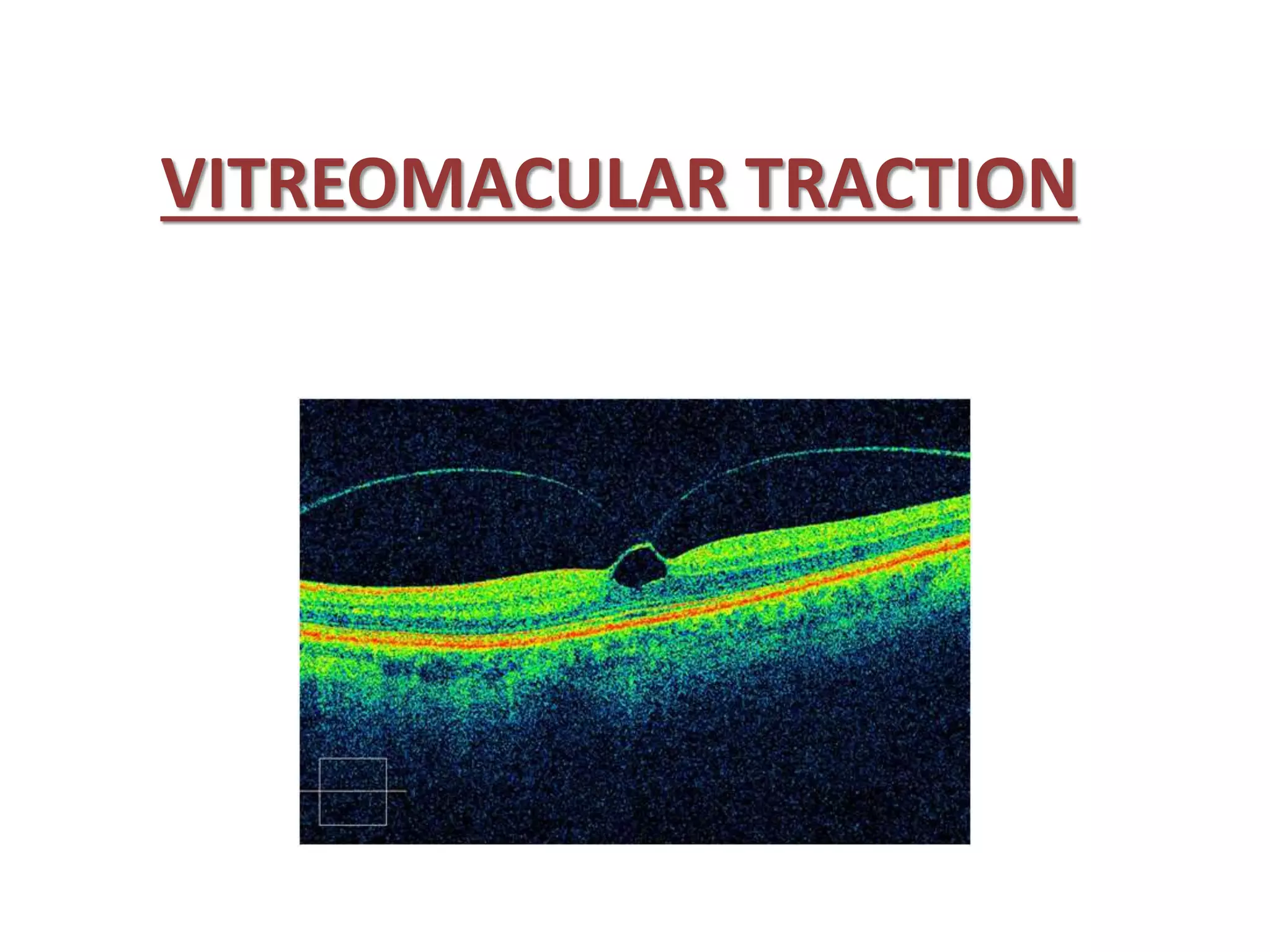 Vitreomacular traction | PPTX