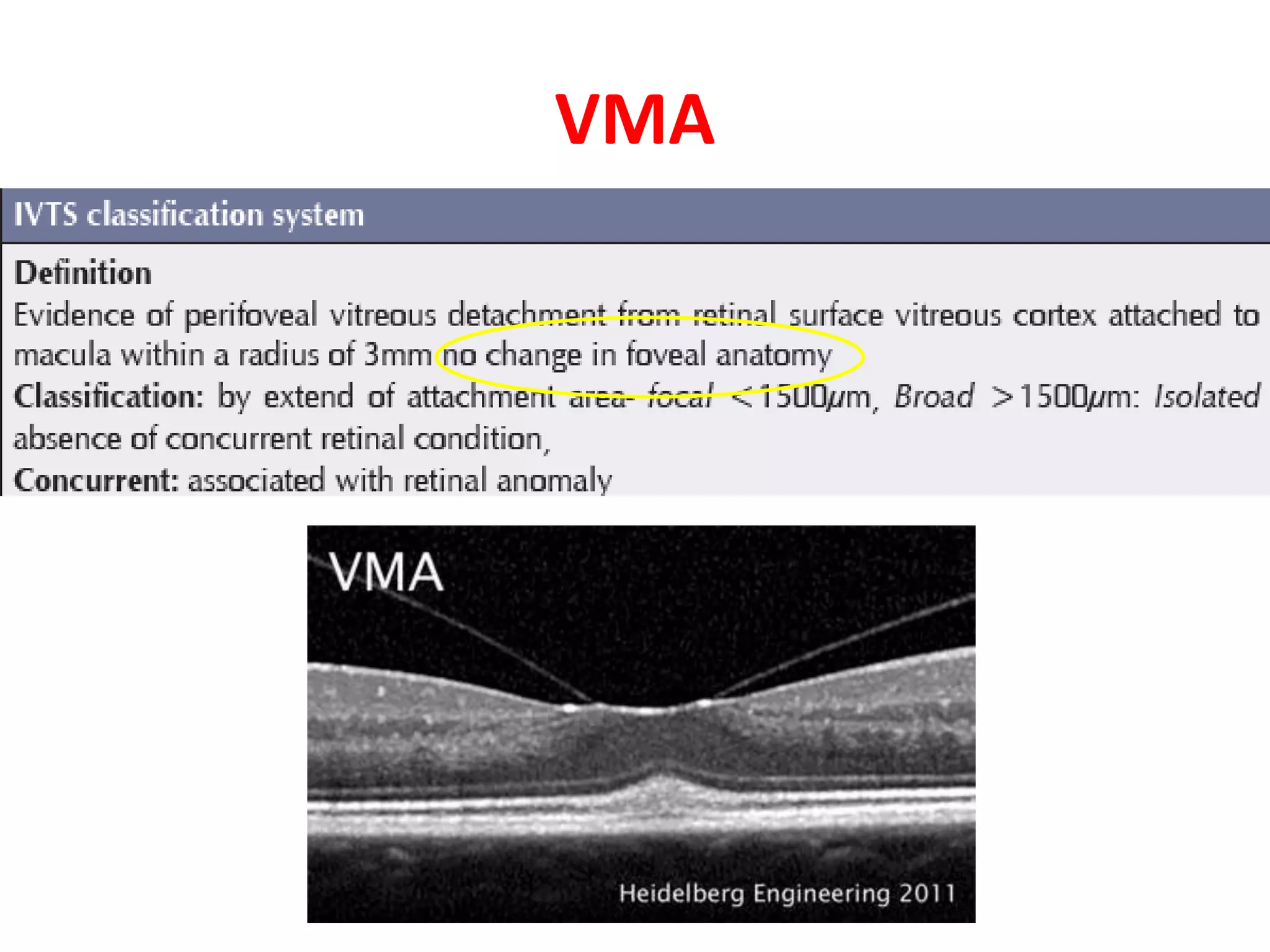 Vitreomacular traction | PPTX