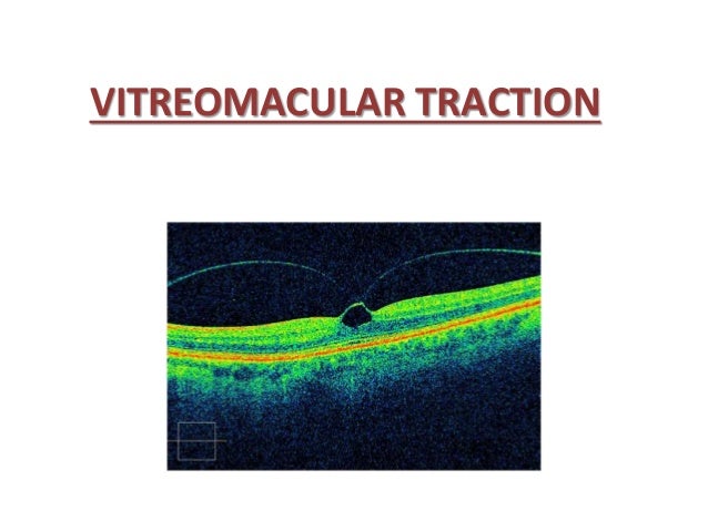 Vitreomacular traction
