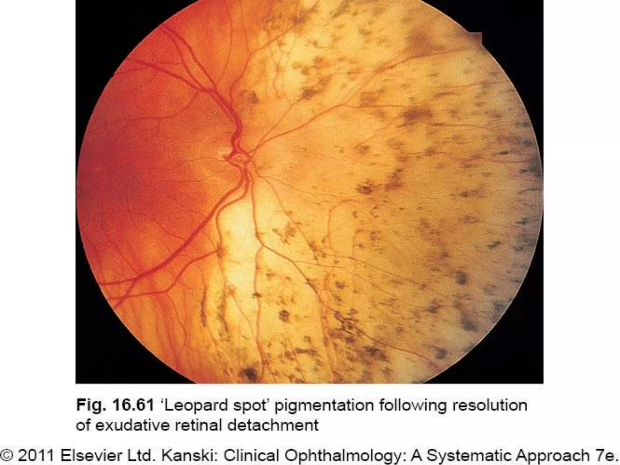 Vitreoretinal pathology (shared using VisualBee) | PPT