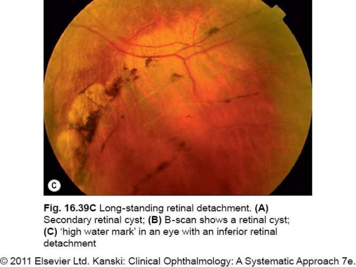Vitreoretinal pathology (shared using VisualBee)