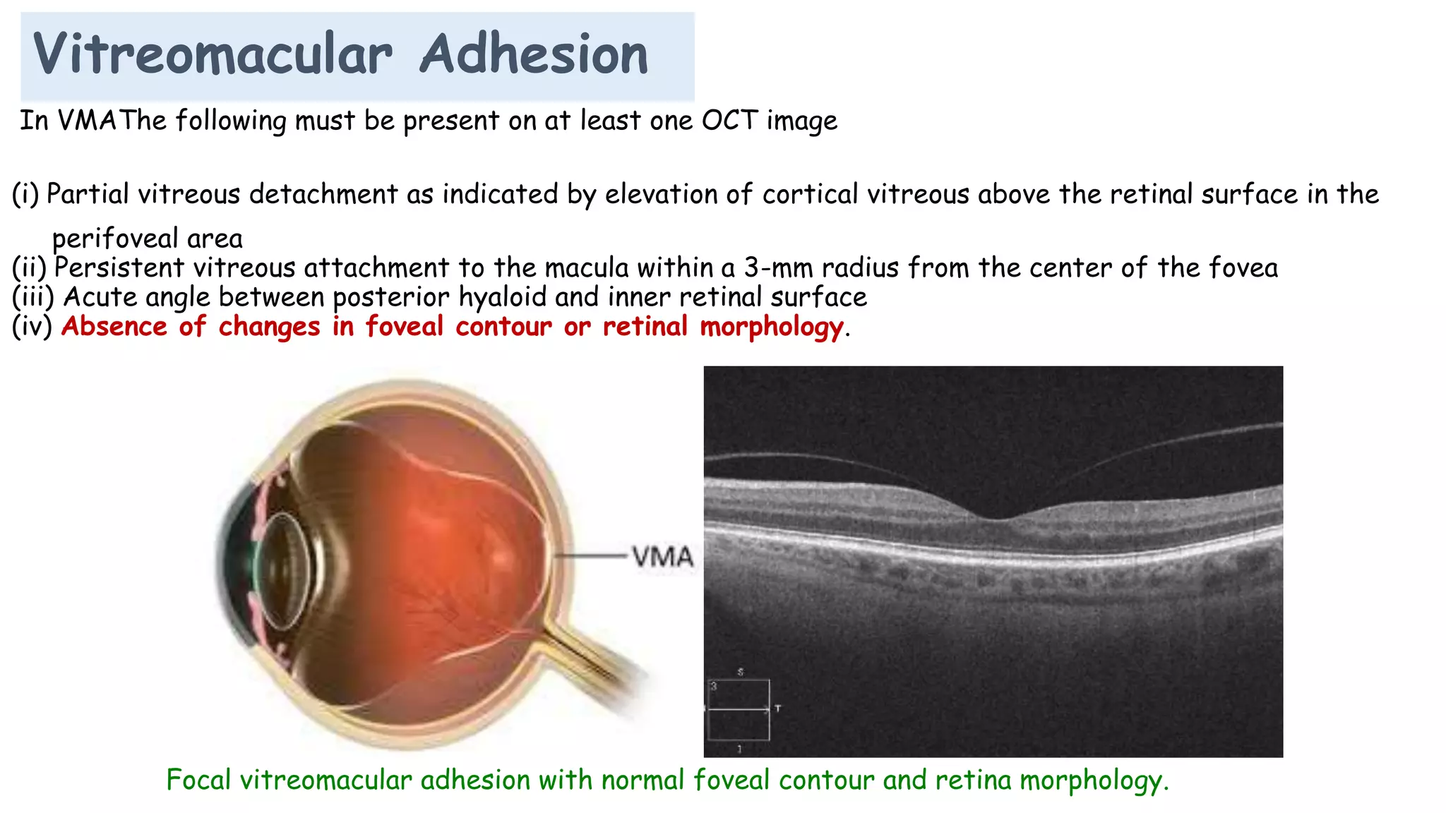 Vitreoretinal interface disorders | PPTX