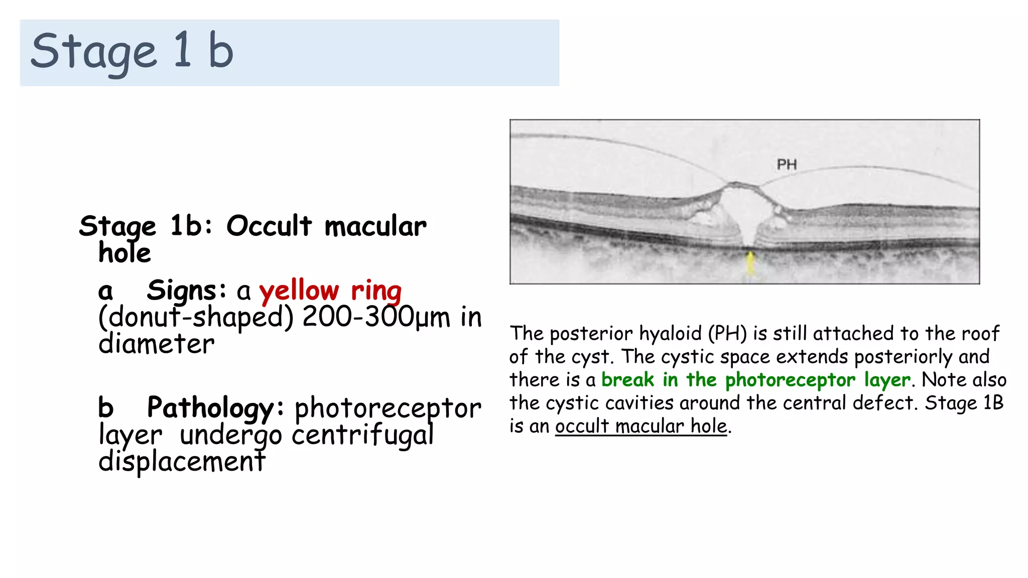 Vitreoretinal interface disorders | PPTX