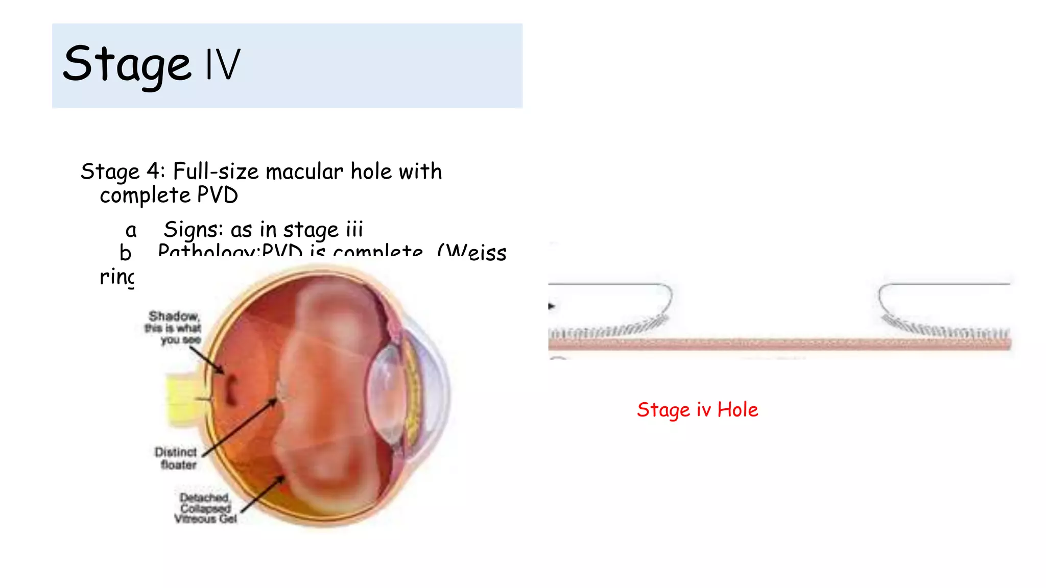 Vitreoretinal interface disorders | PPTX