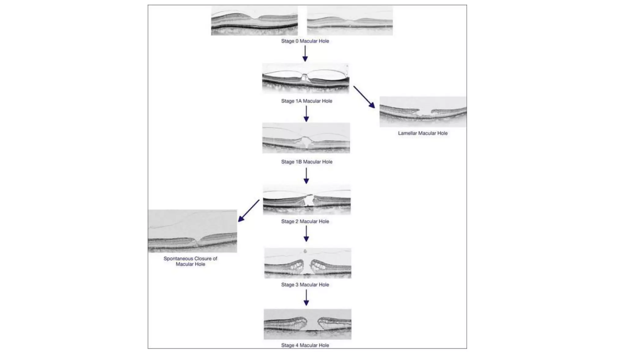 Vitreoretinal interface disorders | PPTX