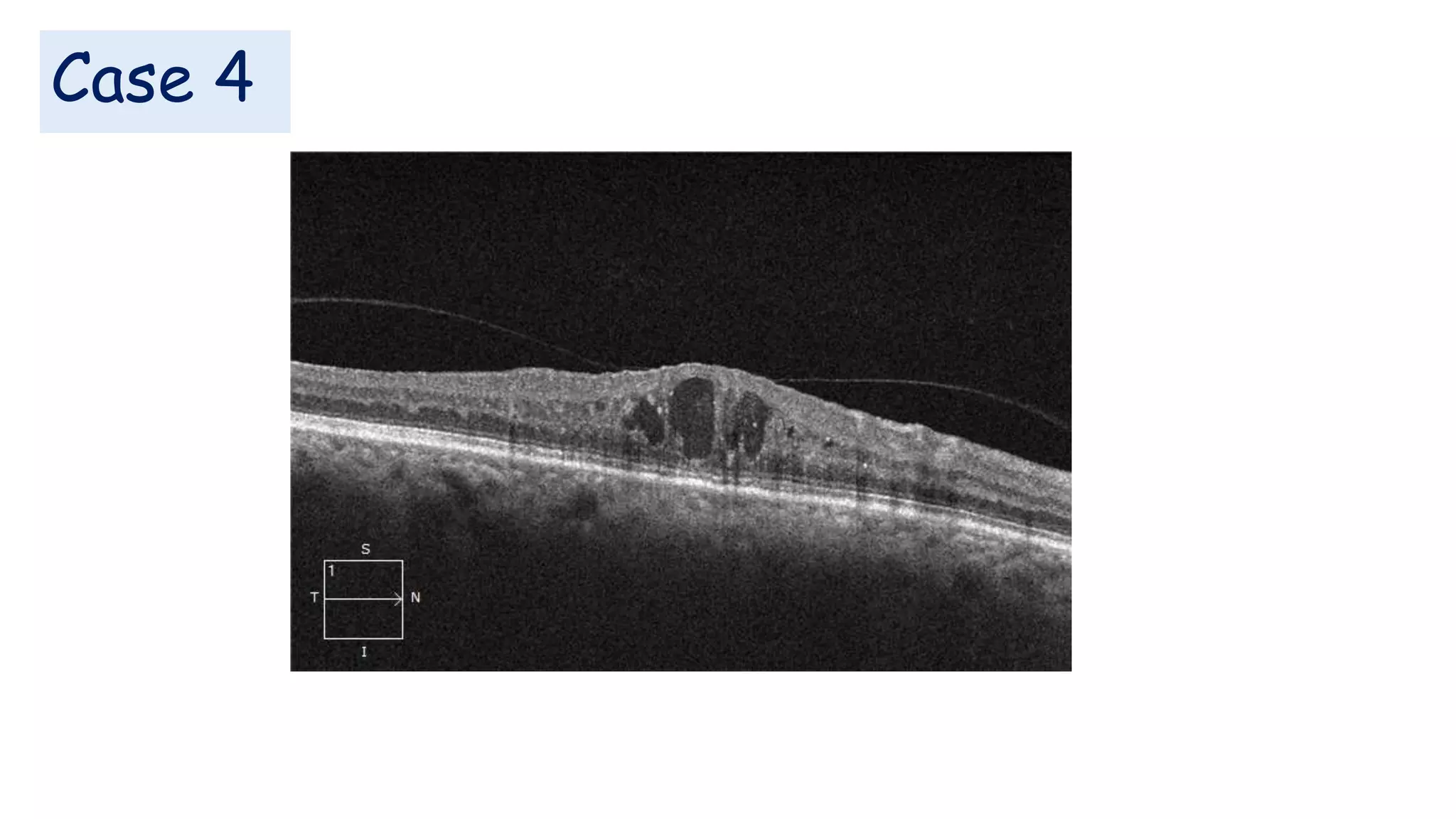 Vitreoretinal interface disorders | PPTX