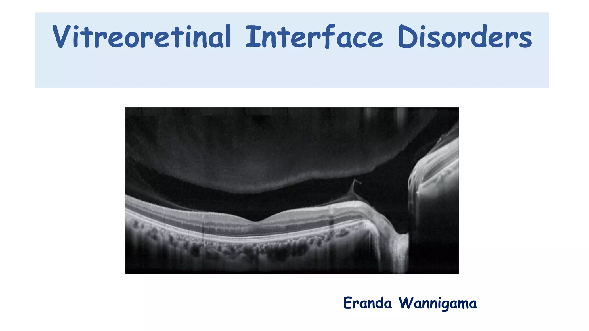 Vitreoretinal Interface Disorders: Diagnosis and Management | PPT