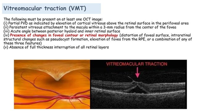 Vitreoretinal interface disorders | PPTX