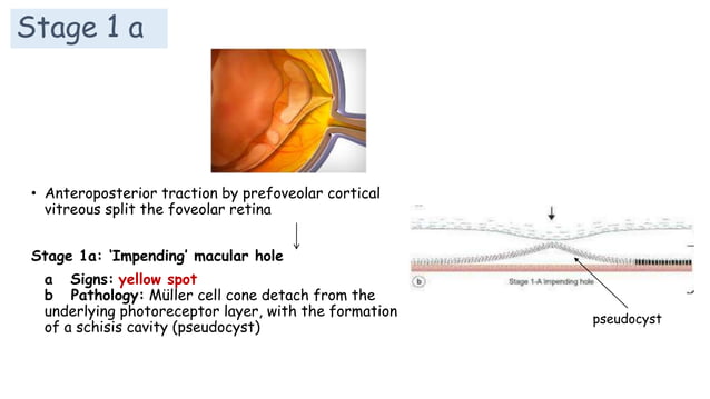 Vitreoretinal interface disorders | PPTX