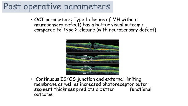 Vitreoretinal interface disorders | PPTX
