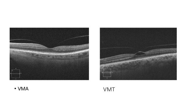 Vitreoretinal interface disorders