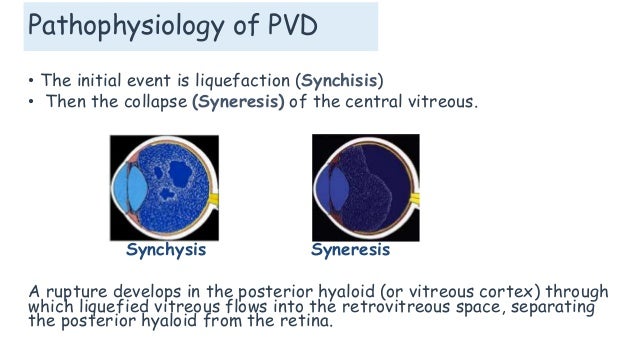 Vitreoretinal interface disorders