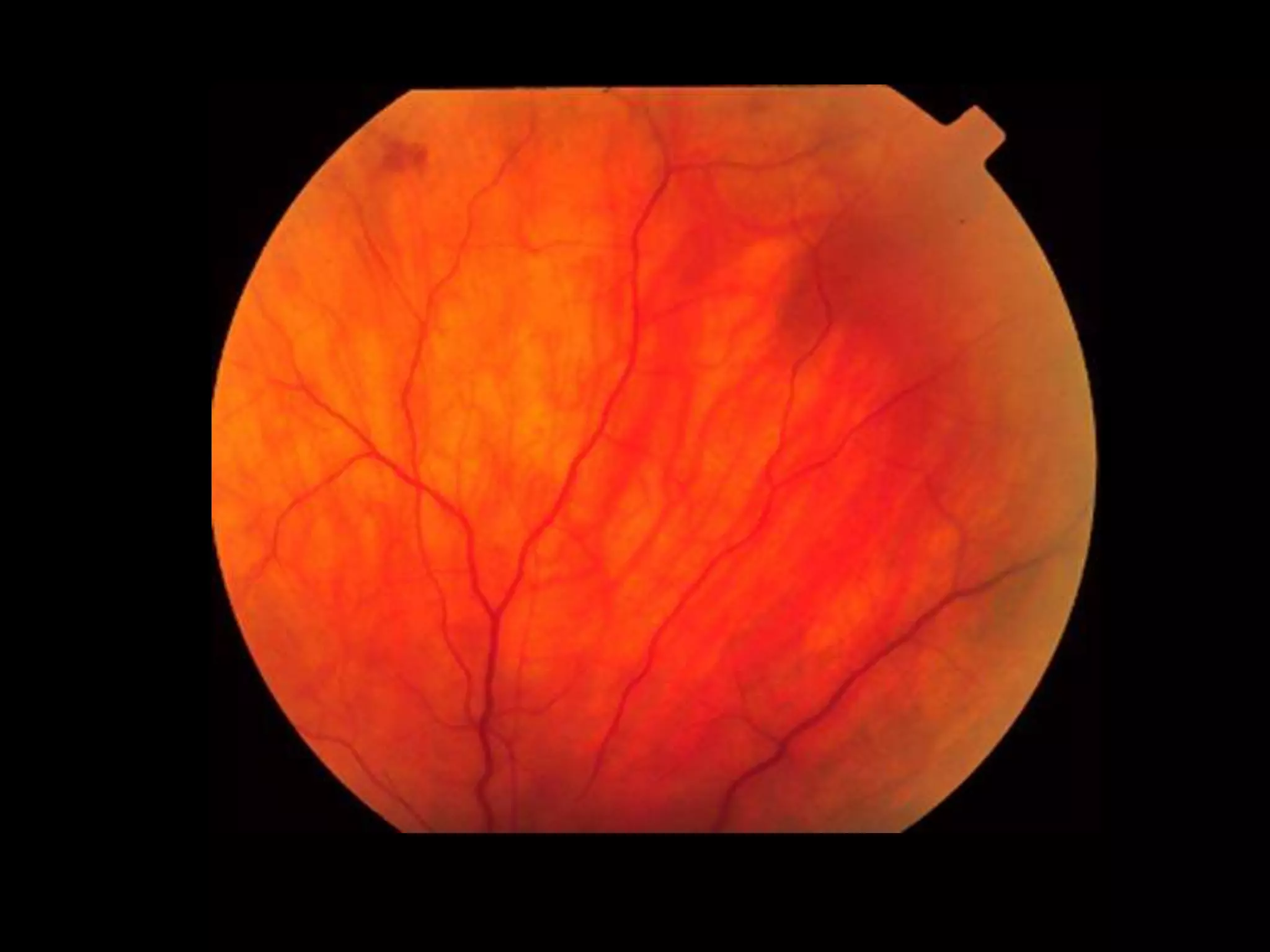 Vitreous | PPTX