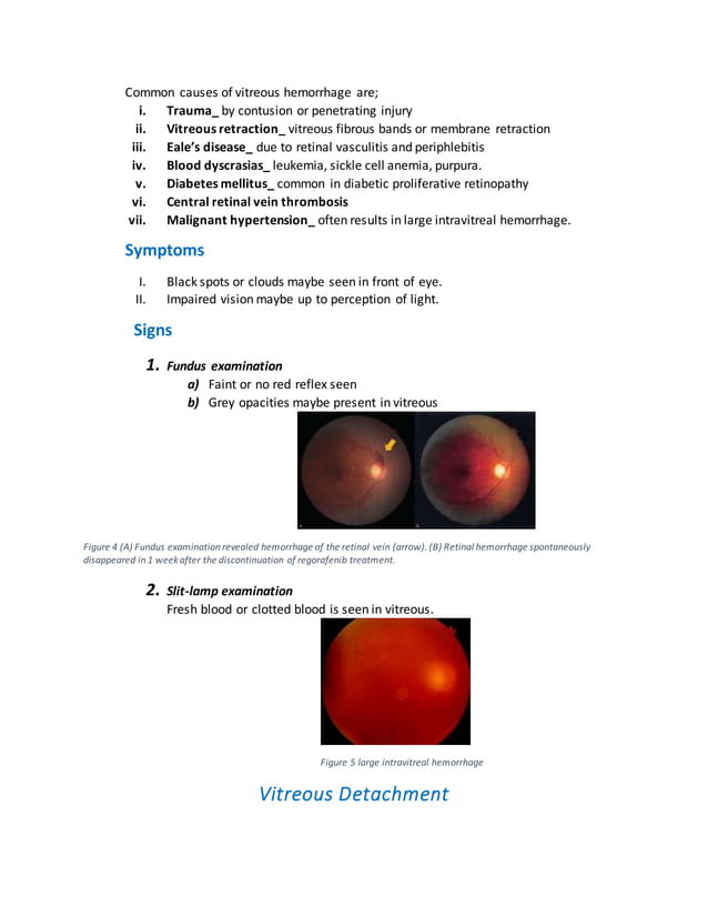 Vitreous (Attachments, age changes, vitreous hemorrhage, Vitreous ...
