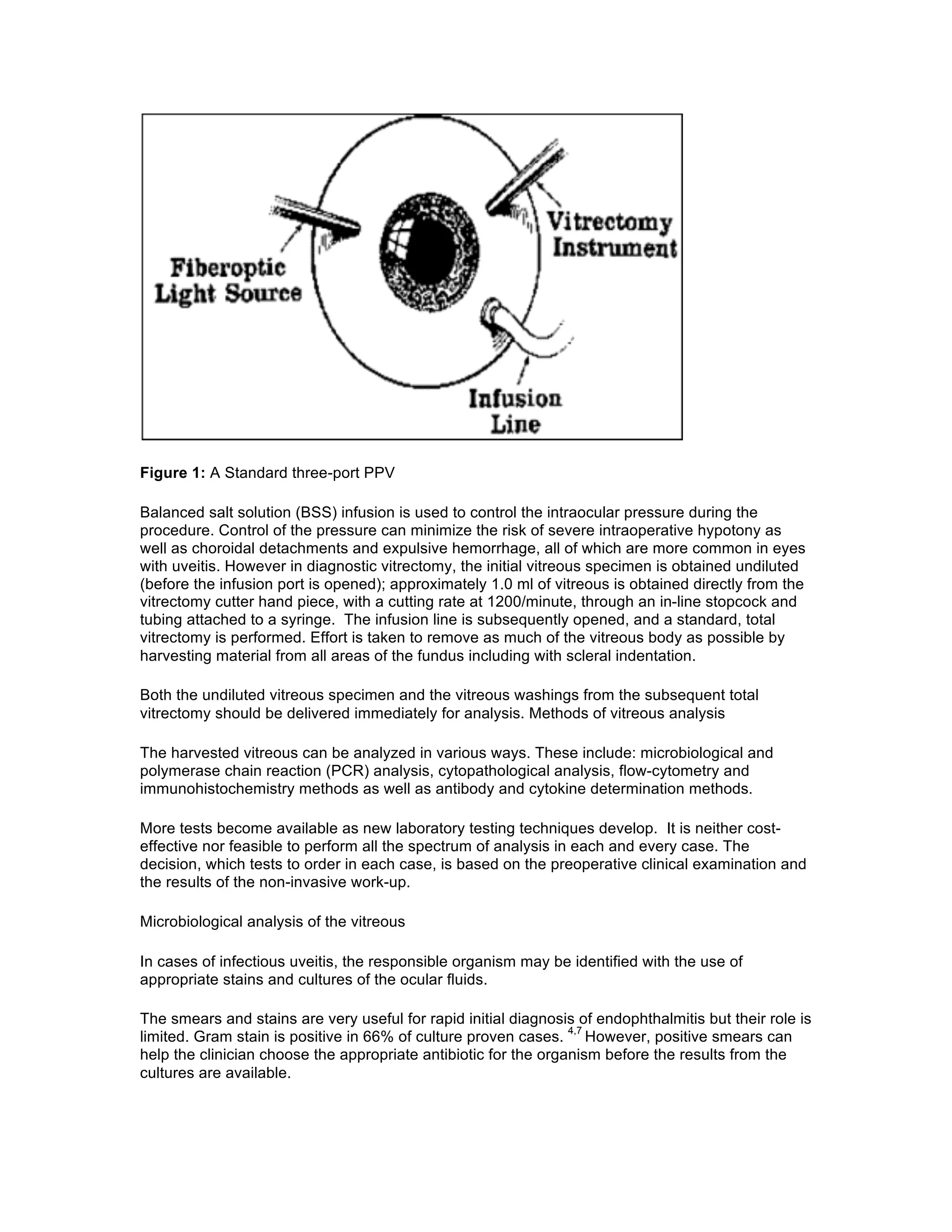 Vitreous biopsy in_the_diagnosis_of_uveitis | PDF