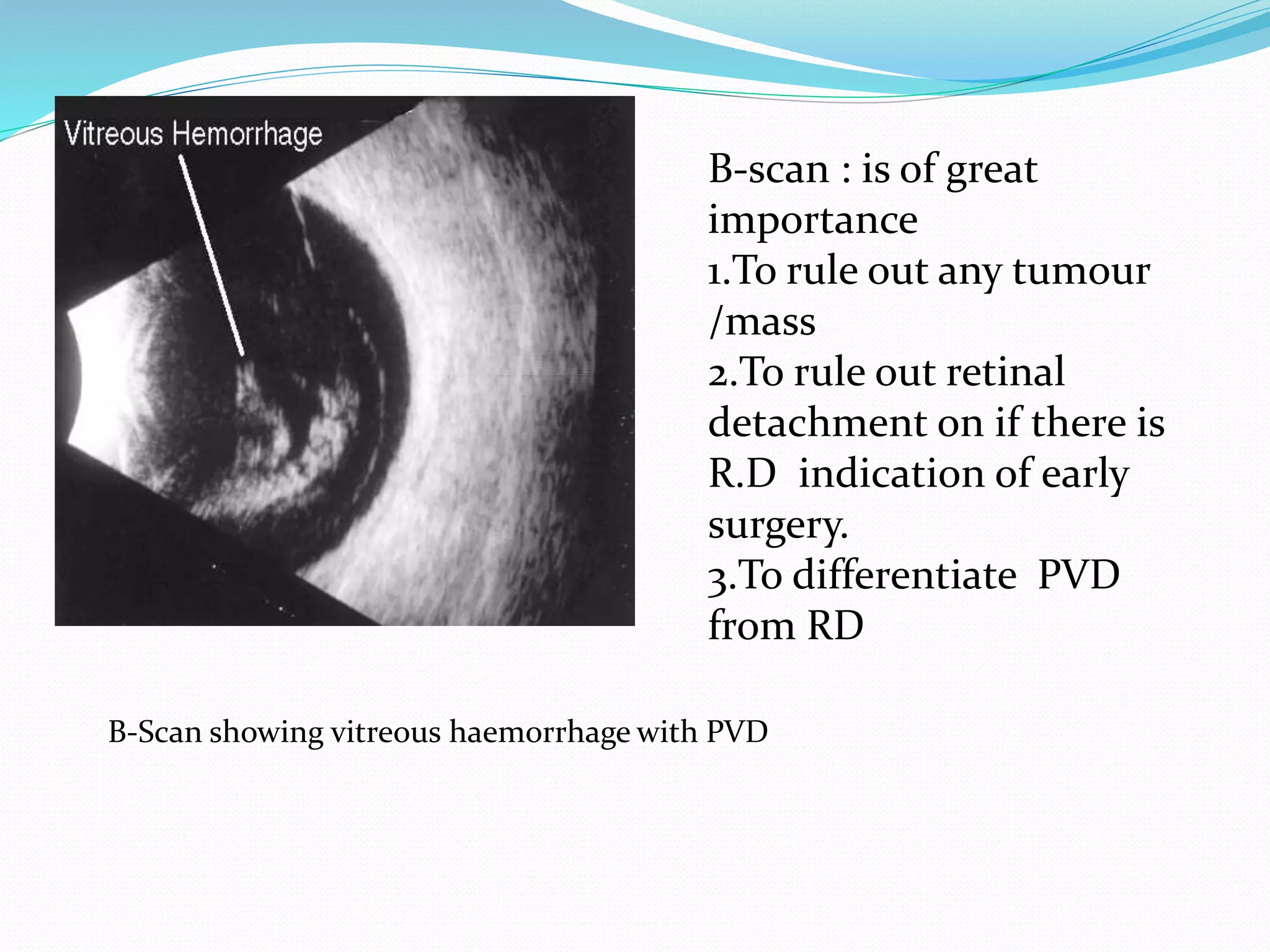 Vitreous hemorrhage | PPTX