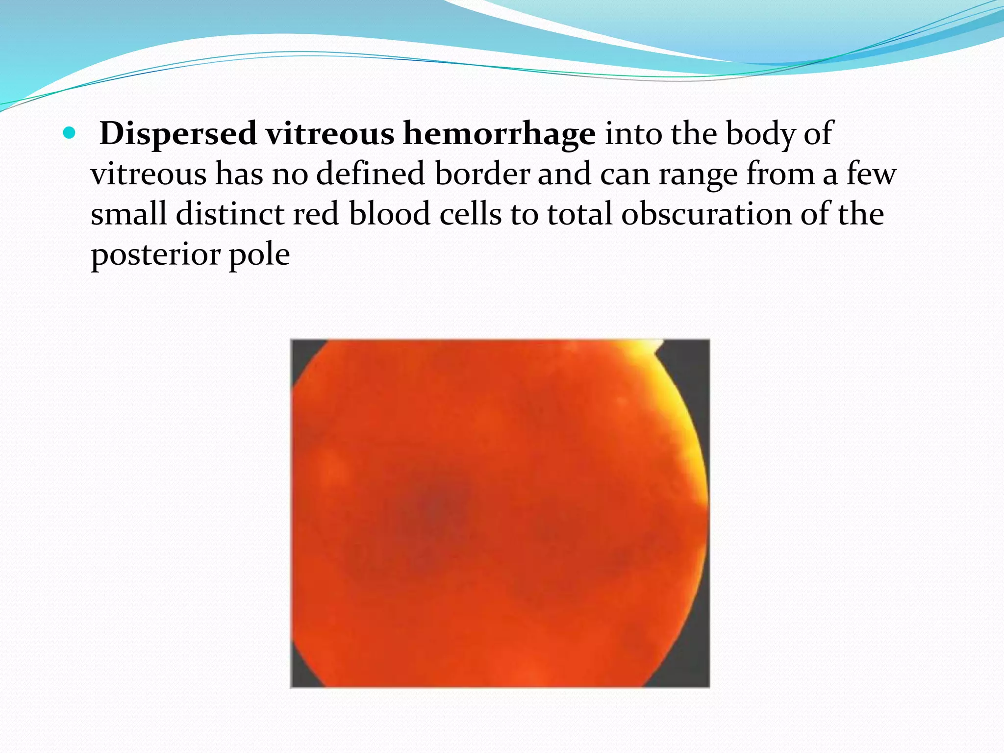 Vitreous hemorrhage | PPTX