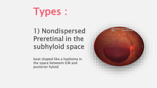 Vitreous hemorrhage | PPTX