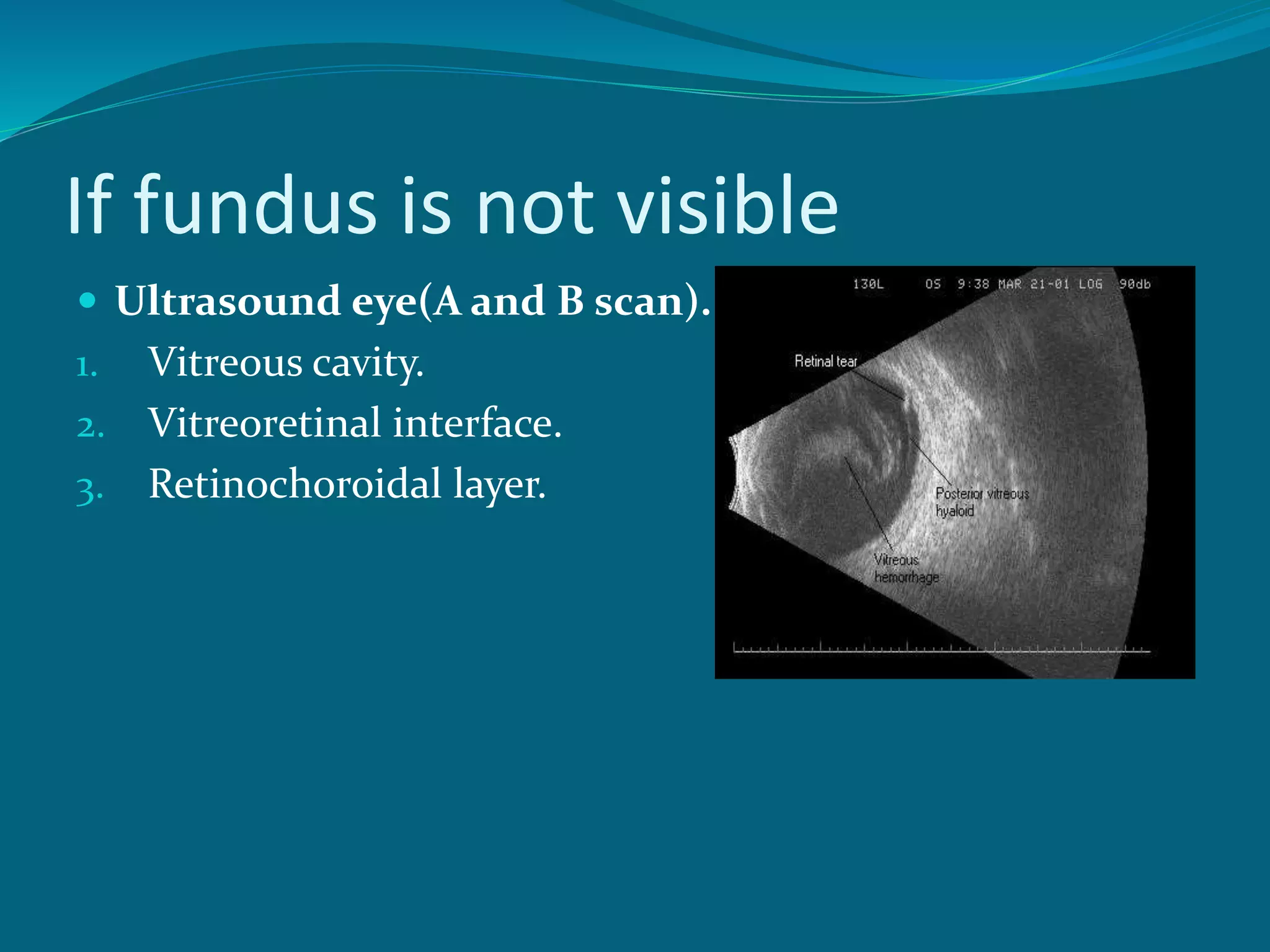 Vitreous hemorrhage | PPTX