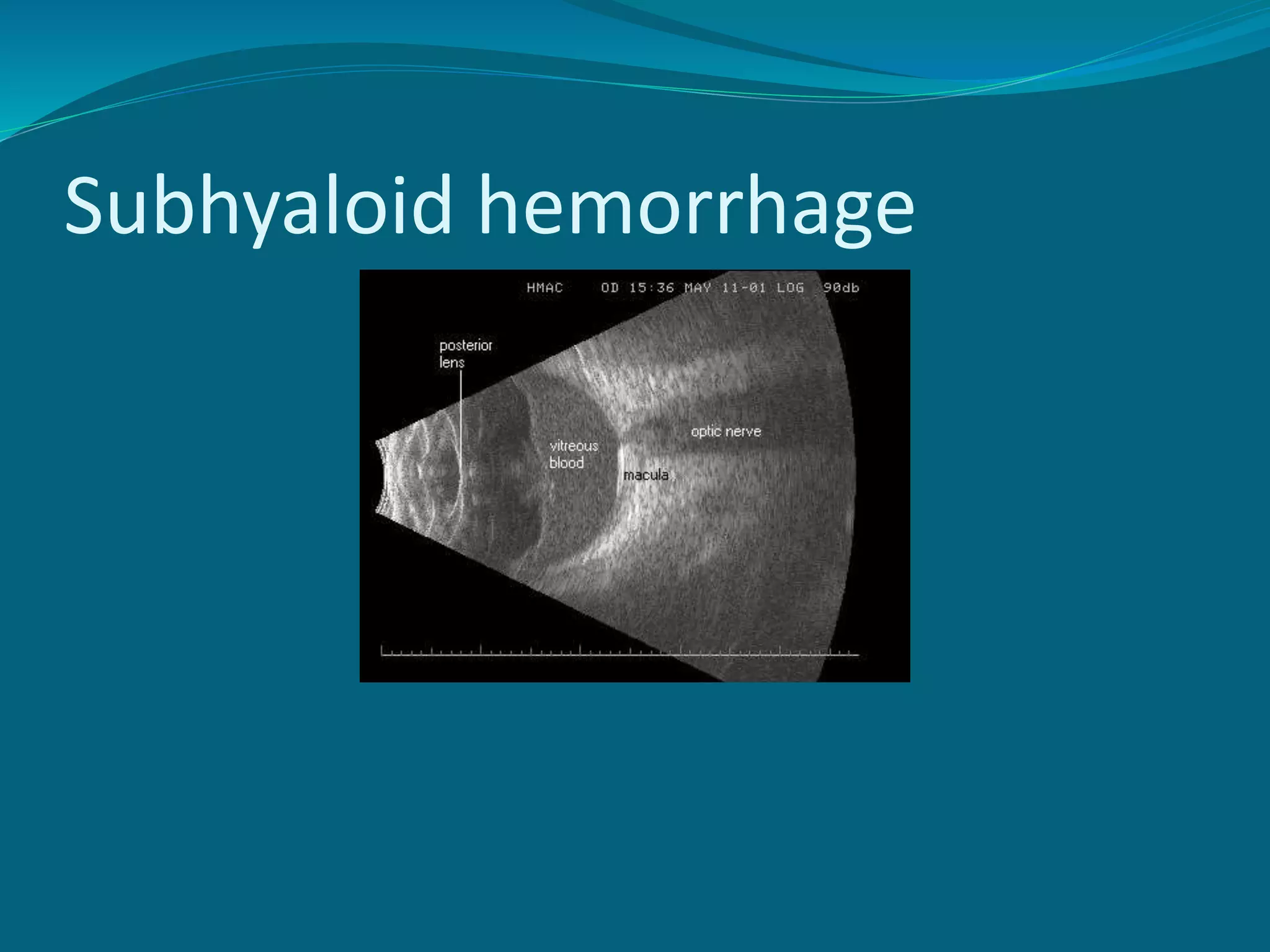Vitreous hemorrhage | PPTX