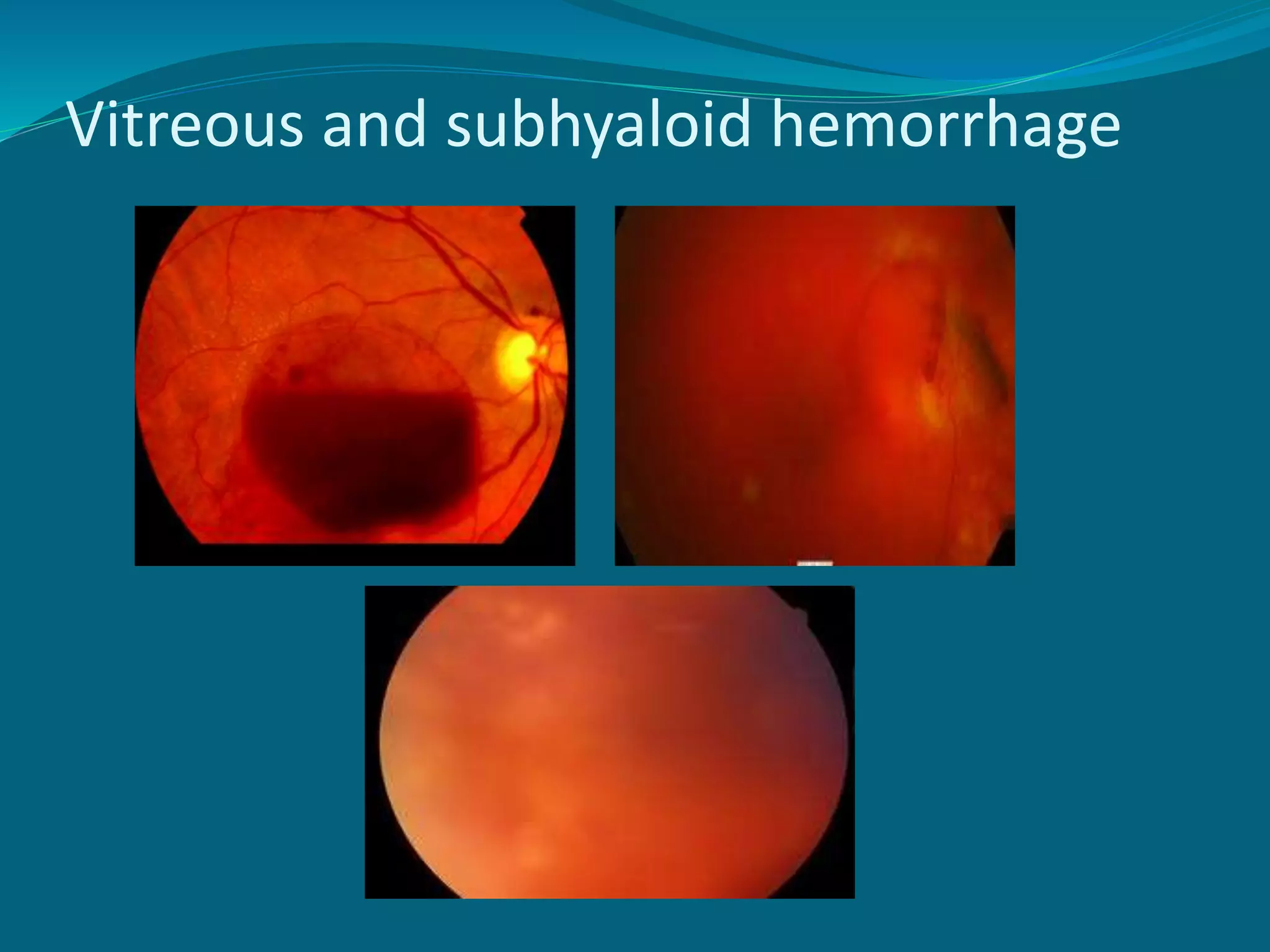 Vitreous hemorrhage | PPTX